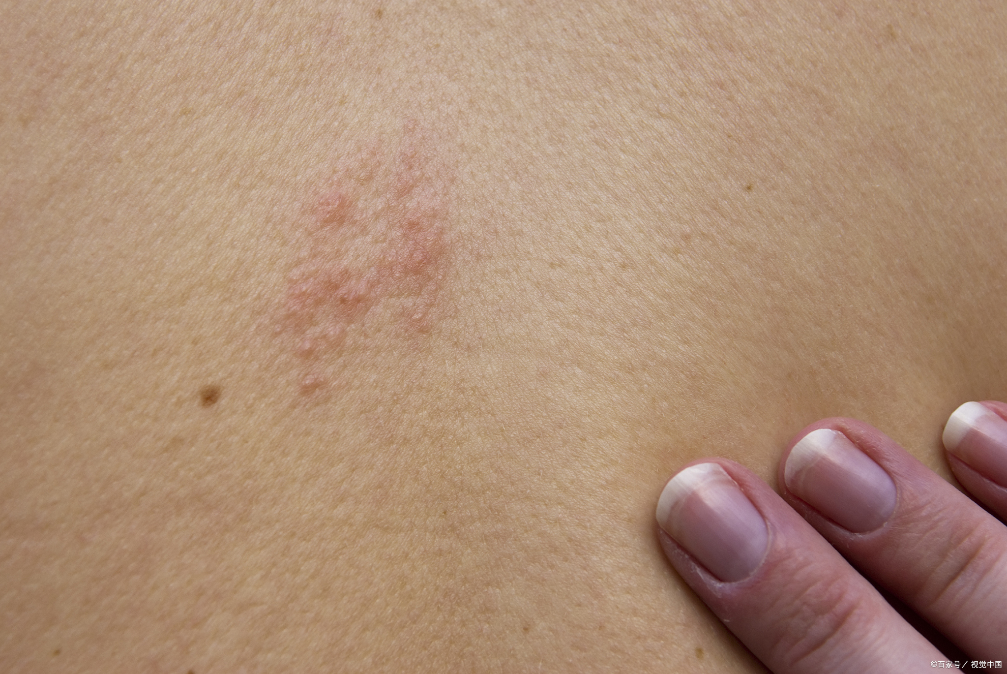 带状疱疹有多“凶”？能治愈吗？听听医生怎么说_百科TA说