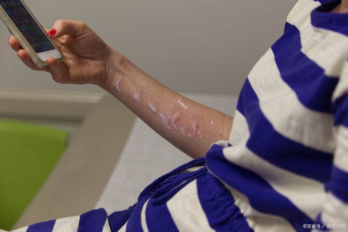 γ-干扰素释放试验（IGRA）相对于PPD实验的优势